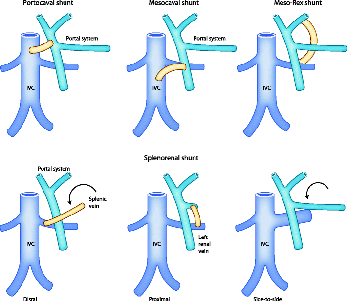 Surgery for Portal Hypertension in Children | SpringerLink