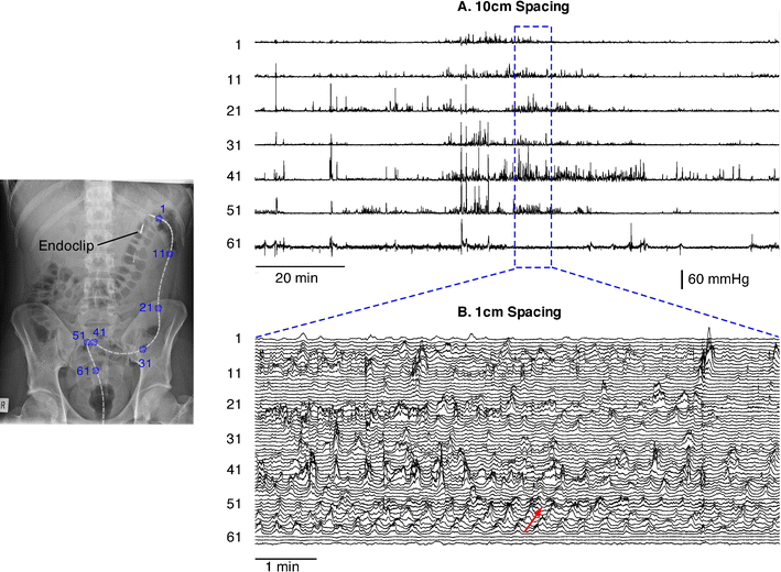 High Resolution Colonic Manometry – What Have We Learnt?- a Review of ...