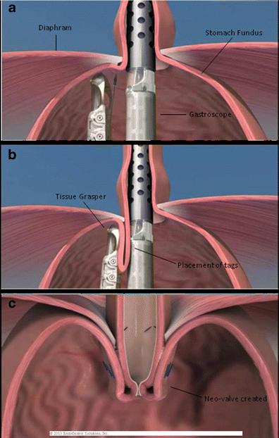 Update in Procedural Therapy for GERD – Magnetic Sphincter Augmentation ...
