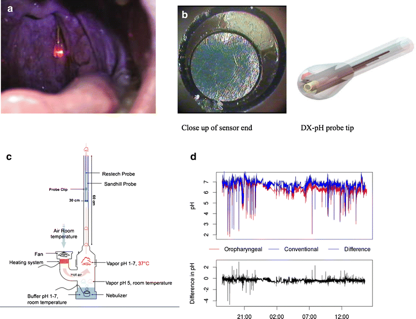 Oropharyngeal Reflux Monitoring and Atypical Gastroesophageal Reflux ...