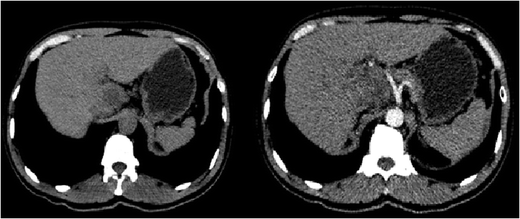 Hepatic and Intra-abdominal Tuberculosis: 2016 Update | SpringerLink