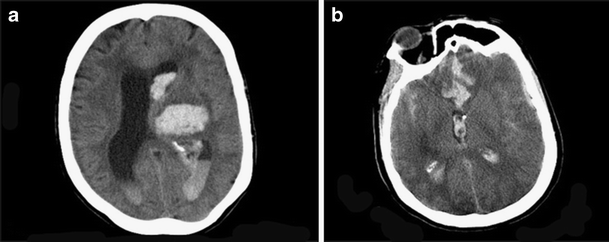 External Ventricular Drainage for Intraventricular Hemorrhage ...