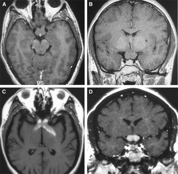 Non-Compressive Disorders of the Chiasm | SpringerLink