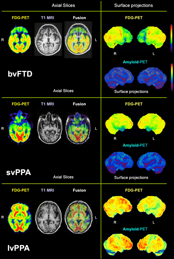 Imaging Frontotemporal Lobar Degeneration | SpringerLink