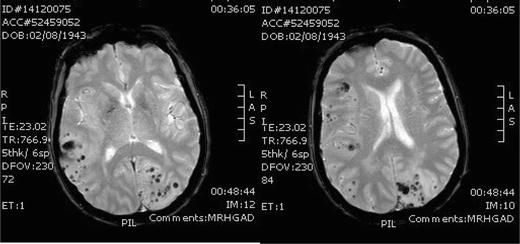 The Inflammatory Form of Cerebral Amyloid Angiopathy or “Cerebral ...