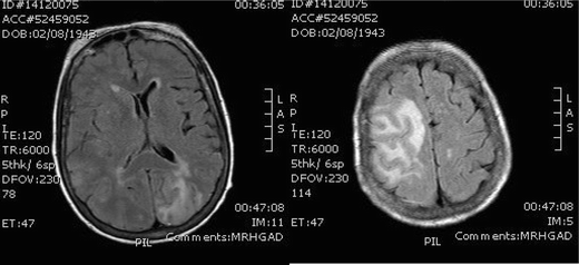 The Inflammatory Form of Cerebral Amyloid Angiopathy or “Cerebral ...