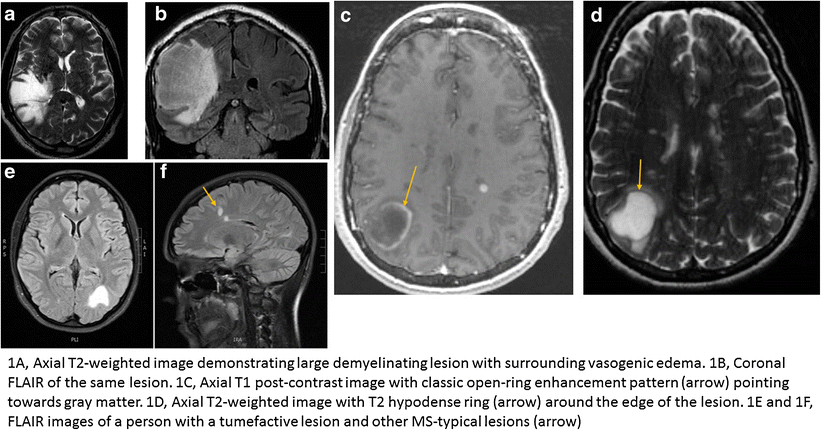 Tumefactive Demyelinating Lesions in Multiple Sclerosis and Associated Disorders | SpringerLink