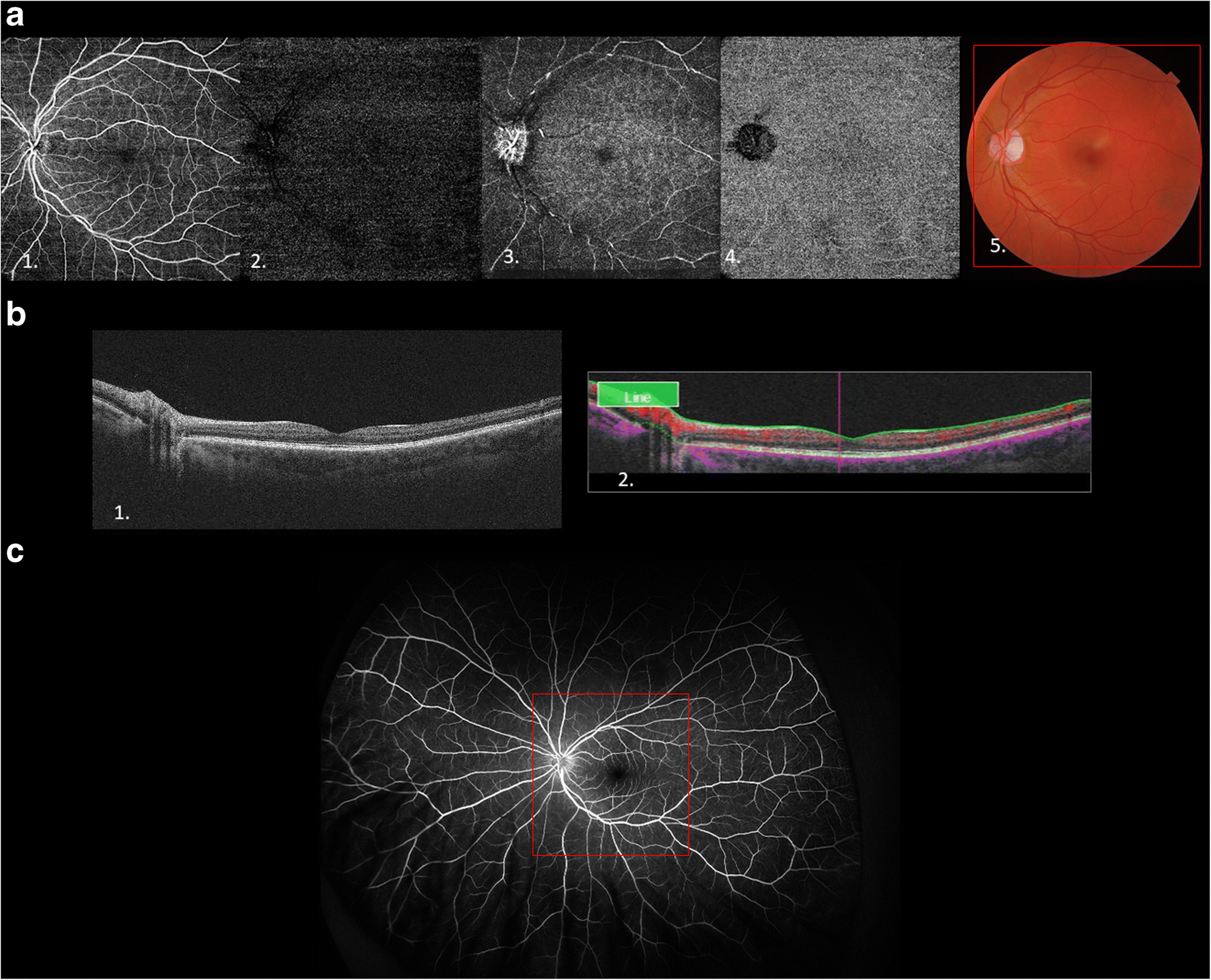 Principles of OCTA and Applications in Clinical Neurology | SpringerLink