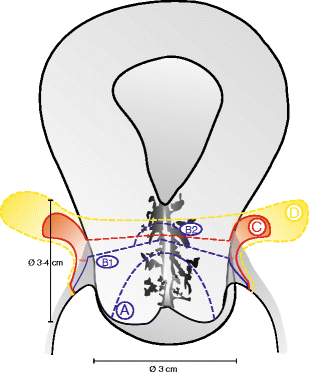 Review of Neoadjuvant Chemotherapy and Trachelectomy: Which Cervical ...