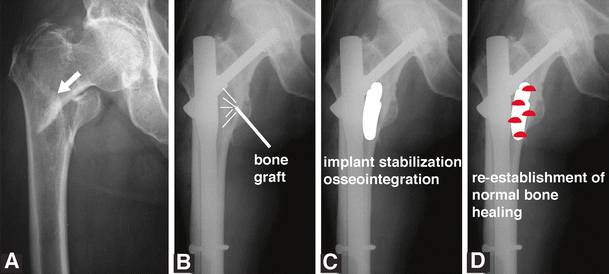 Biomaterial Scaffolds for Treating Osteoporotic Bone | SpringerLink