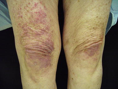Cutaneous Manifestations of Dermatomyositis and Their Management ...
