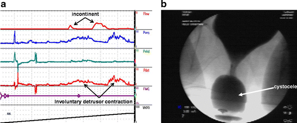 How Do Urodynamics Findings Influence the Treatment of the Typical ...