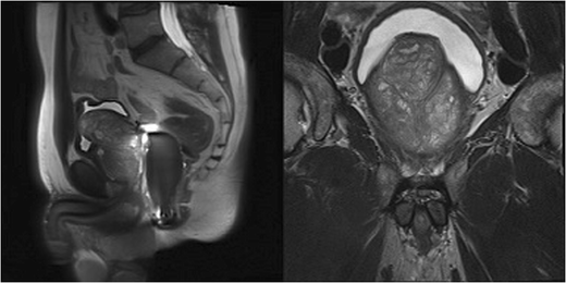 Holmium Laser Enucleation of the Prostate: Patient Selection and ...