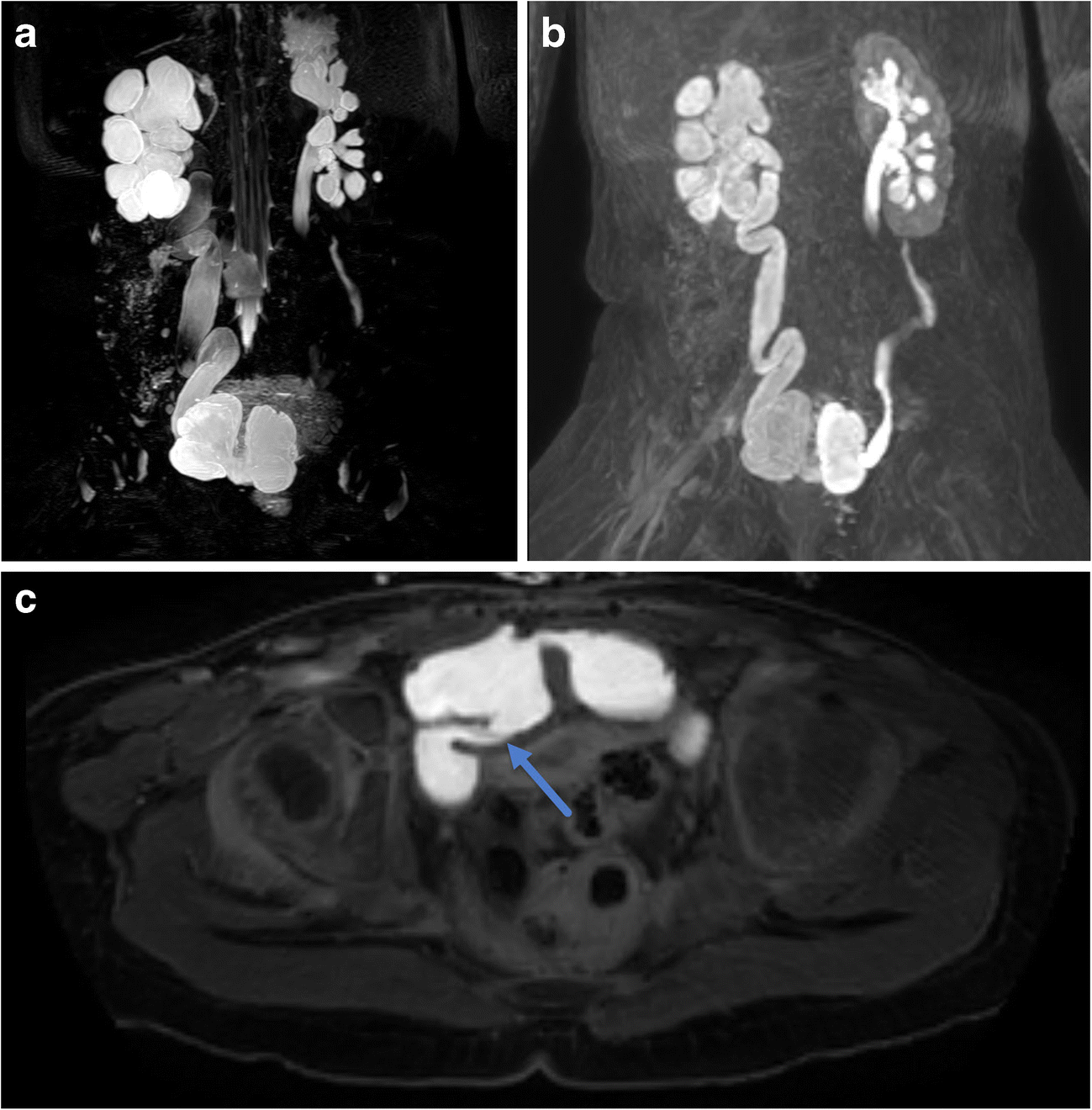 Use of MR Urography in Pediatric Patients | SpringerLink