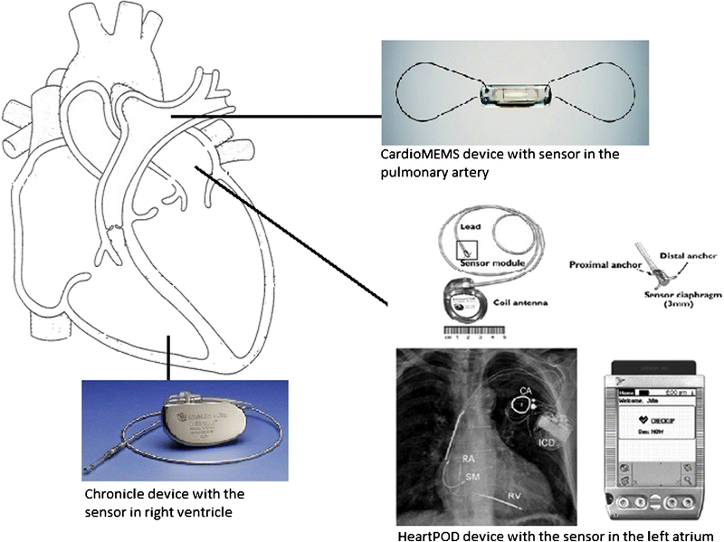 Update on Device Technologies for Monitoring Heart Failure | SpringerLink