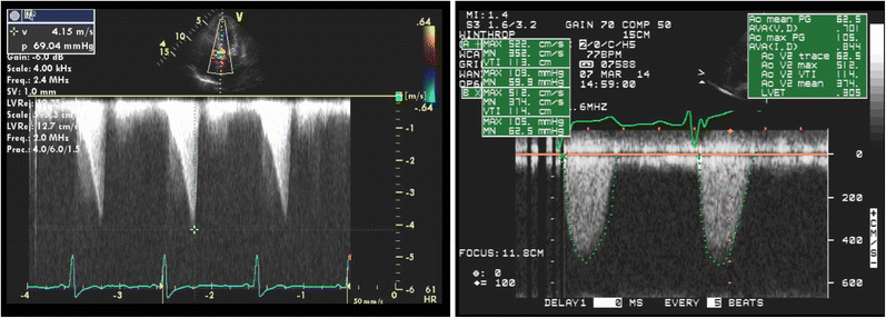 Evaluation and Management of Concomitant Hypertrophic Obstructive ...