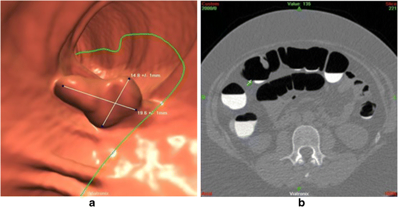 Screening and Surveillance of Colorectal Cancer Using CT Colonography ...
