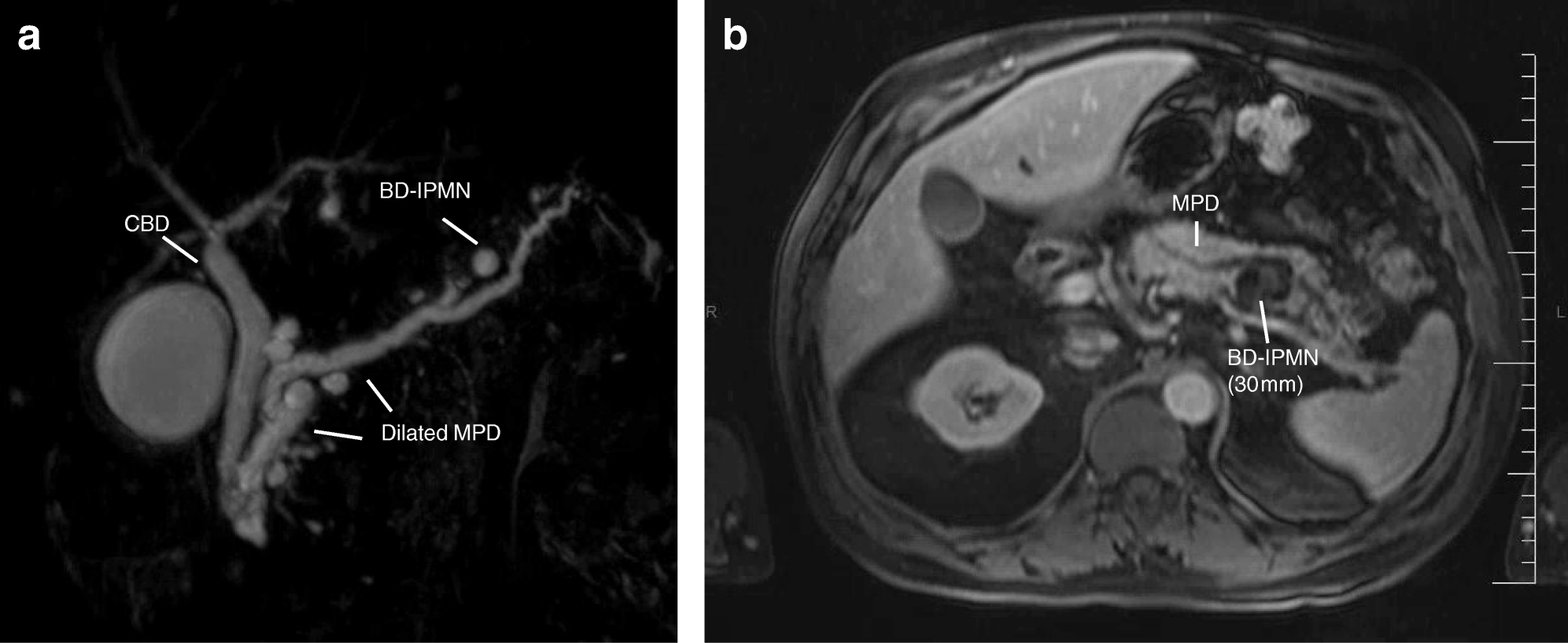 Management Of Intraductal Papillary Mucinous Neoplasms Controversies