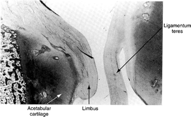 The Limbus and the Neolimbus in Developmental Dysplasia of the Hip ...