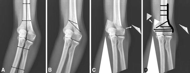 Oblique Closing Wedge Osteotomy and Lateral Plating for Cubitus Varus ...