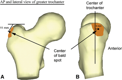 Anatomy of the Greater Trochanteric ‘Bald Spot’: A Potential Portal for ...