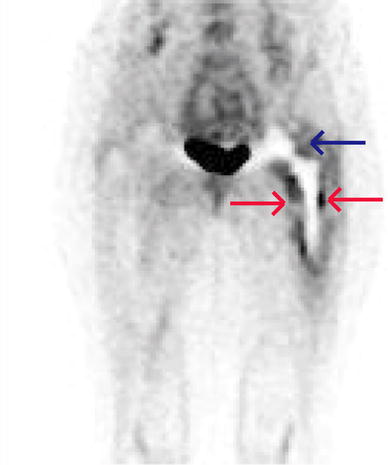FDG-PET Imaging Can Diagnose Periprosthetic Infection of the Hip ...