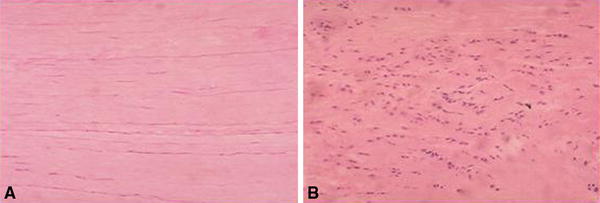 The Basic Science of Tendinopathy | SpringerLink