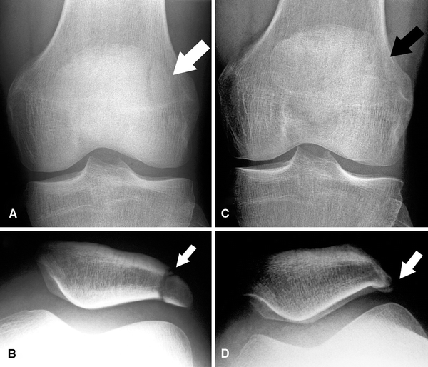 Excision of Painful Bipartite Patella: Good Long-term Outcome in Young ...