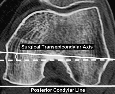 Rotational Position of Femoral and Tibial Components in TKA Using the ...