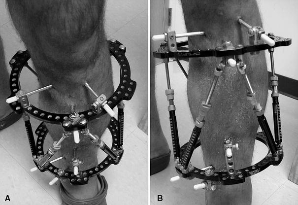 Circular External Fixation Frames with Divergent Half Pins: A Pilot ...