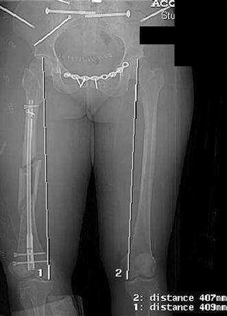 Methods for Assessing Leg Length Discrepancy | SpringerLink
