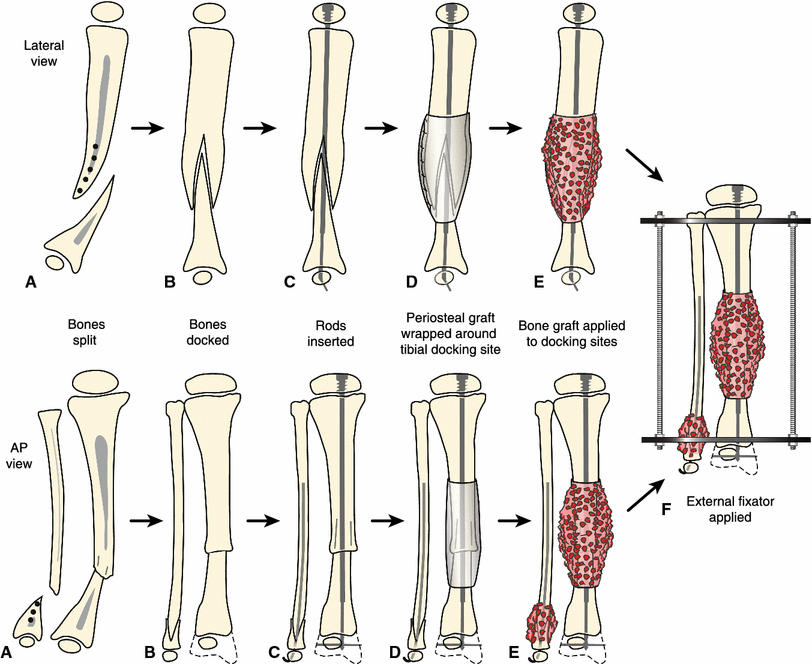 Periosteal Grafting for Congenital Pseudarthrosis of the Tibia: A ...