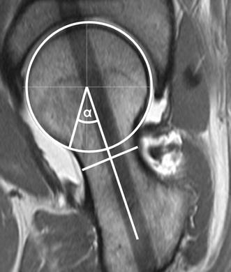 Do Normal Radiographs Exclude Asphericity of the Femoral Head-Neck ...
