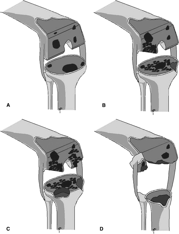 Limitations of Structural Allograft in Revision Total Knee Arthroplasty ...