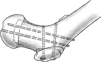 Capital Realignment for Moderate and Severe SCFE Using a Modified Dunn ...