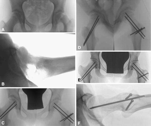 Capital Realignment for Moderate and Severe SCFE Using a Modified Dunn ...