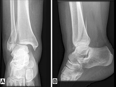 Supination-External Rotation Ankle Fractures: Stability a Key Issue ...
