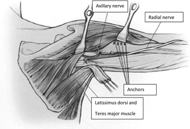 Modified L’Episcopo Tendon Transfers for Irreparable Rotator Cuff Tears ...
