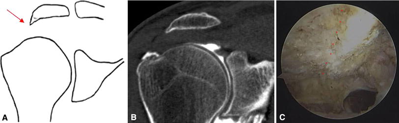 Classification and Clinical Significance of Acromial Spur in Rotator ...