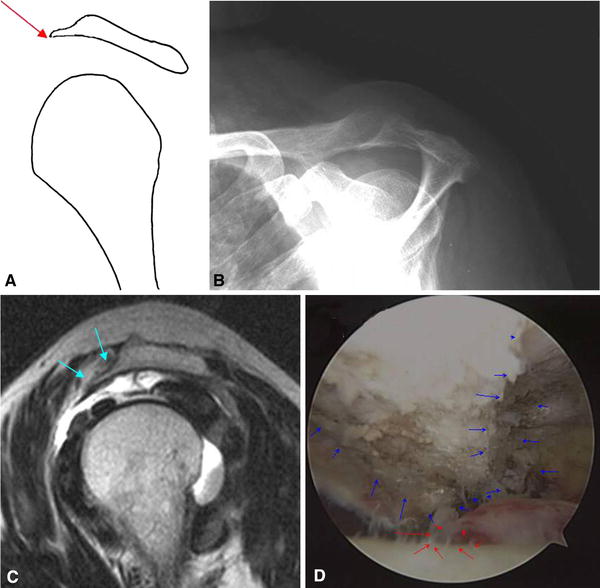 Classification and Clinical Significance of Acromial Spur in Rotator ...