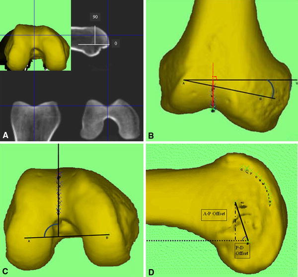 The Geometry of the Trochlear Groove | SpringerLink