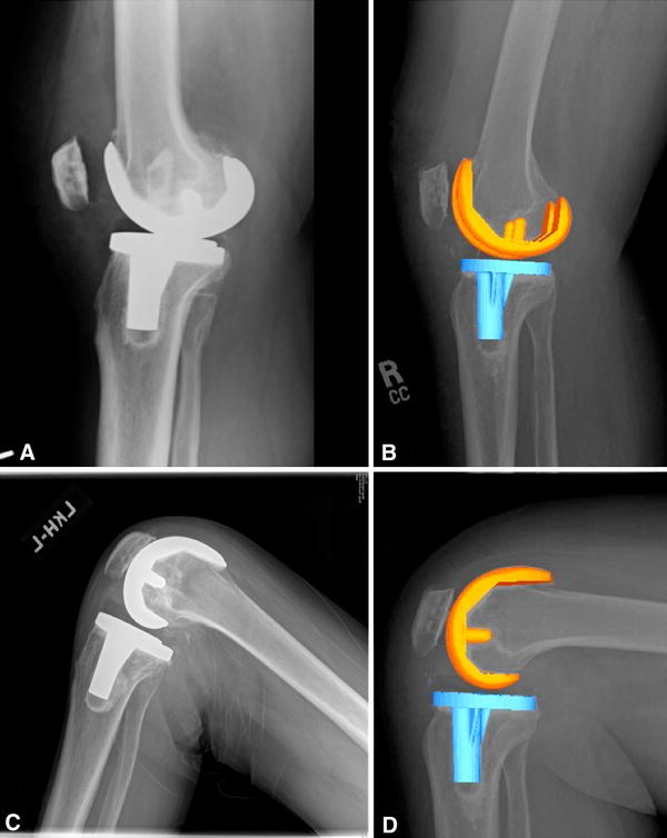 Does a Modified Gap-balancing Technique Result in Medial-pivot Knee ...