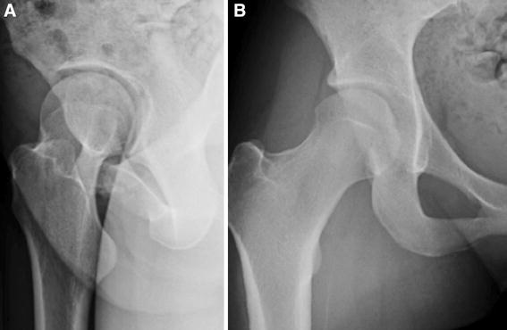Coxa Profunda: Is the Deep Acetabulum Overcovered? | SpringerLink