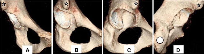 Anterior Inferior Iliac Spine Morphology Correlates With Hip Range of ...