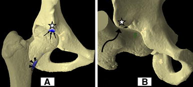 Anterior Inferior Iliac Spine Morphology Correlates With Hip Range of ...