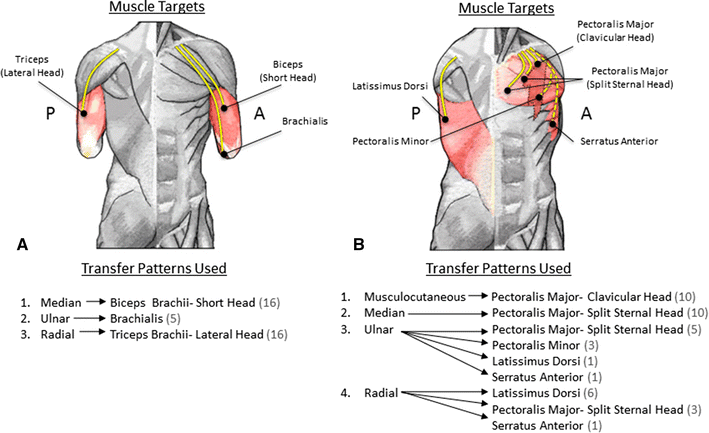 Targeted Muscle Reinnervation: A Novel Approach to Postamputation ...