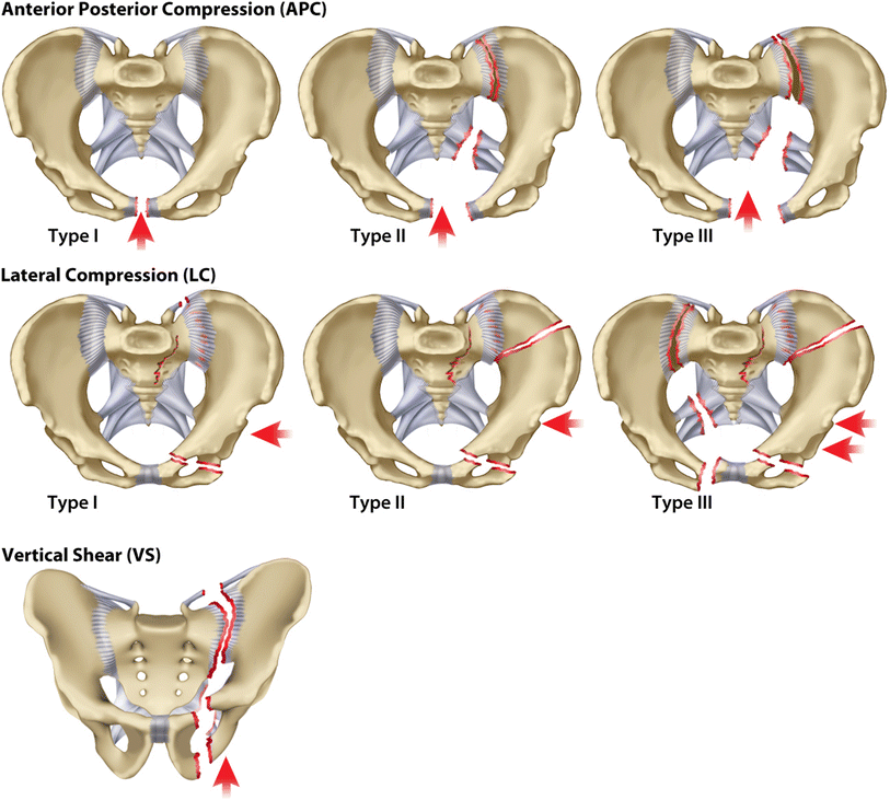 Classifications in Brief: Young and Burgess Classification of Pelvic ...