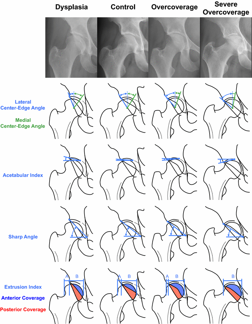 What Are the Radiographic Reference Values for Acetabular Under- and ...