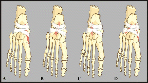 How Do Different Anterior Tibial Tendon Transfer Techniques Influence ...
