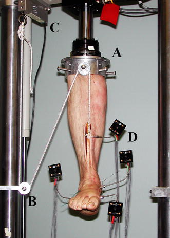 How Do Different Anterior Tibial Tendon Transfer Techniques Influence ...